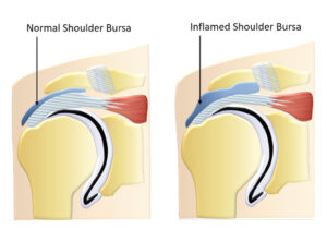 Ergo Info: Bursitis - OHCOW