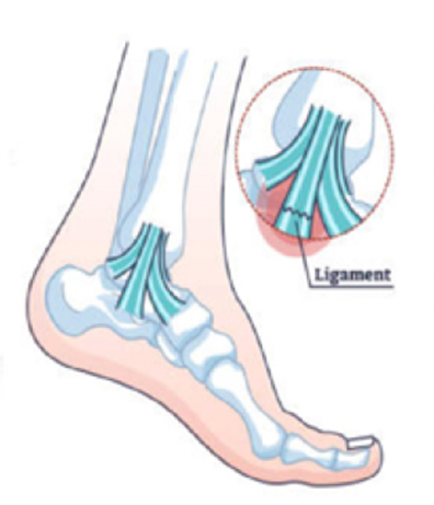 Ergo Info: Ligament Strain/Tear - OHCOW