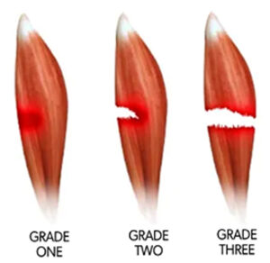 Ergo Info: Muscle Strain/Tear - OHCOW